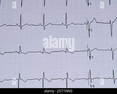 ECG ElectroCardioGraph paper that shows inferolateral T wave changes ...
