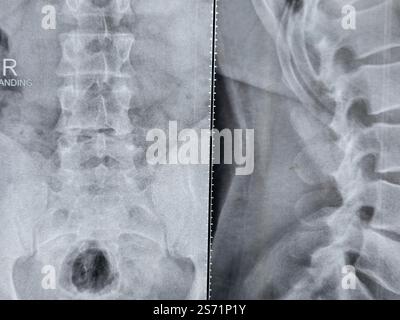 X-ray lumbosacral spine shows straightening of lumbar lordosis due to ...