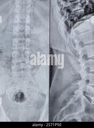 X-ray lumbosacral spine shows straightening of lumbar lordosis due to ...