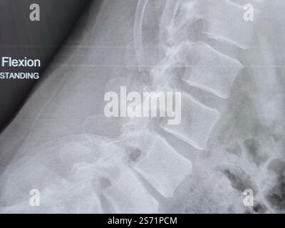 X-ray lumbosacral spine shows straightening of lumbar lordosis due to ...