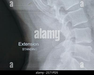 X-ray lumbosacral spine shows straightening of lumbar lordosis due to ...