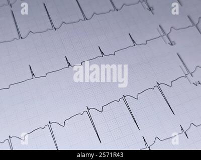 an electrocardiogram ECG or EKG, within normal ECG for a 55 years old ...