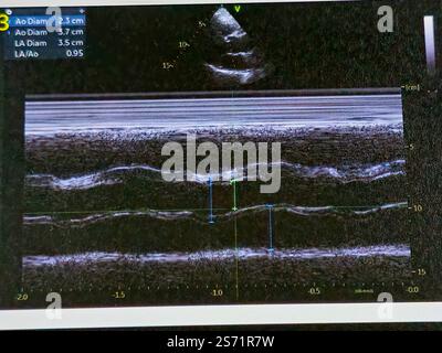 Echocardiography or cardiac ultrasound shows normal values except for ...