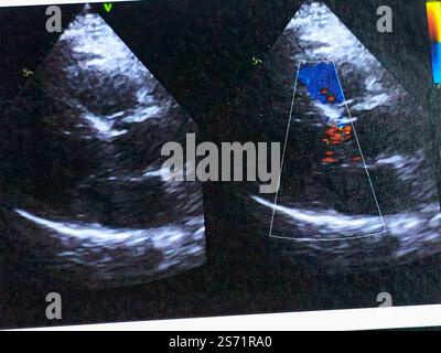 Echocardiography or cardiac ultrasound shows normal values except for ...