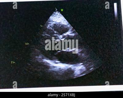 Echocardiography or cardiac ultrasound shows normal values except for ...