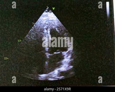 Echocardiography or cardiac ultrasound shows normal values except for ...