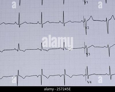 ECG ElectroCardioGraph paper that shows inferolateral T wave changes ...