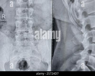 X-ray lumbosacral spine shows straightening of lumbar lordosis due to ...