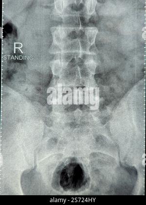 X-ray lumbosacral spine shows straightening of lumbar lordosis due to ...