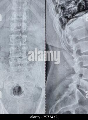 X-ray lumbosacral spine shows straightening of lumbar lordosis due to ...