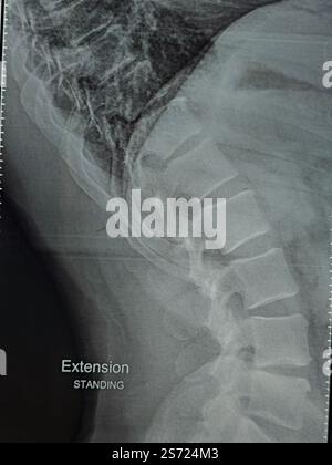 X-ray lumbosacral spine shows straightening of lumbar lordosis due to ...