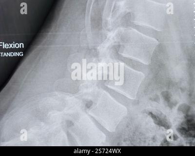X-ray lumbosacral spine shows straightening of lumbar lordosis due to ...