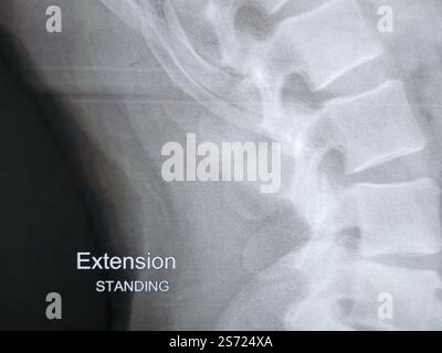 X-ray lumbosacral spine shows straightening of lumbar lordosis due to ...