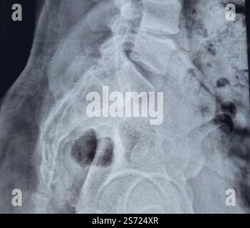 X-ray lumbosacral spine shows straightening of lumbar lordosis due to ...