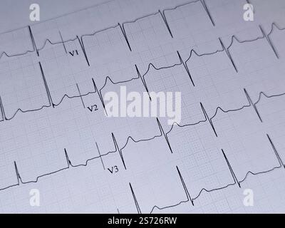 an electrocardiogram ECG or EKG, within normal ECG for a 55 years old ...