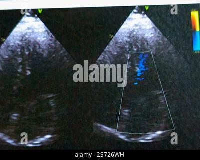 Echocardiography or cardiac ultrasound shows normal values except for ...