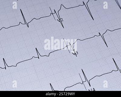 ECG ElectroCardioGraph paper that shows inferolateral T wave changes ...