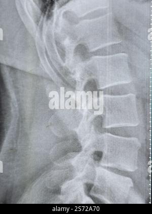 X-ray lumbosacral spine shows straightening of lumbar lordosis due to ...