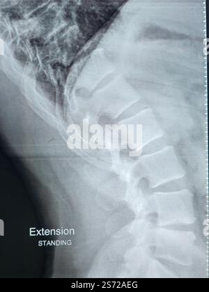 Examination of scoliotic deformity of the lumbar spine. Scoliosis is ...