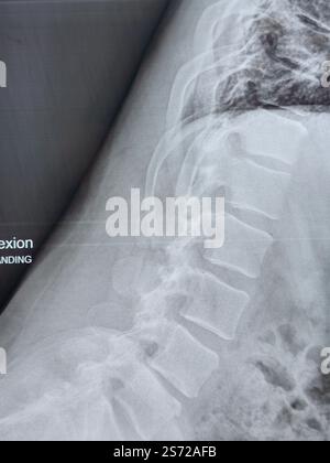 X-ray lumbosacral spine shows straightening of lumbar lordosis due to ...