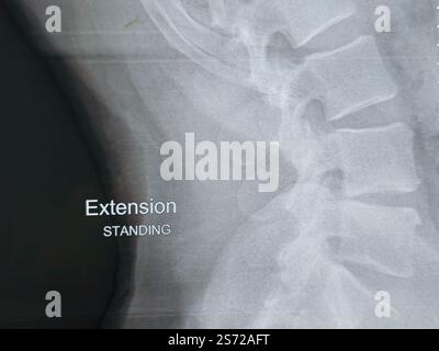 X-ray lumbosacral spine shows straightening of lumbar lordosis due to ...