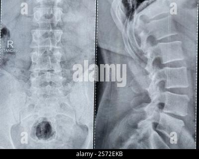 X-ray lumbosacral spine shows straightening of lumbar lordosis due to ...