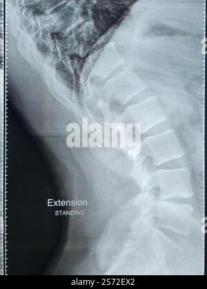 X-ray lumbosacral spine shows straightening of lumbar lordosis due to ...