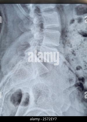 Examination of scoliotic deformity of the lumbar spine. Scoliosis is ...