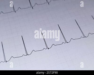 an electrocardiogram ECG or EKG, within normal ECG for a 55 years old ...