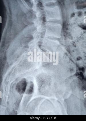 X-ray lumbosacral spine shows straightening of lumbar lordosis due to ...
