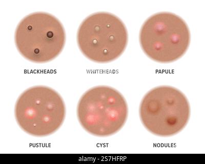 Types of Acne, Pimples Blackheads, Whitehead, Papules, Cystic and ...