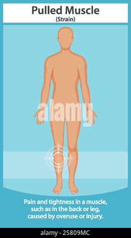 Illustration of muscle strain in human body Stock Vector Image & Art ...