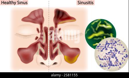 Medical illustration of symptoms of Sinusitis Stock Vector Image & Art - Alamy