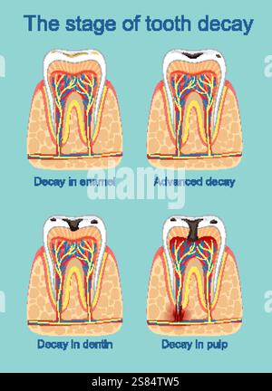 Illustration showing progression of tooth decay stages Stock Vector ...