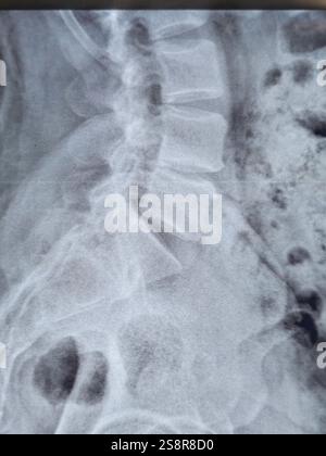 X-ray lumbosacral spine shows straightening of lumbar lordosis due to ...