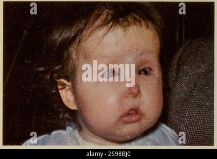 Hallerman-Streiff Syndrome 4 Stock Photo - Alamy