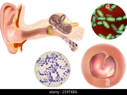 Otitis media is inflammation of the middle ear. bacterial infections ...