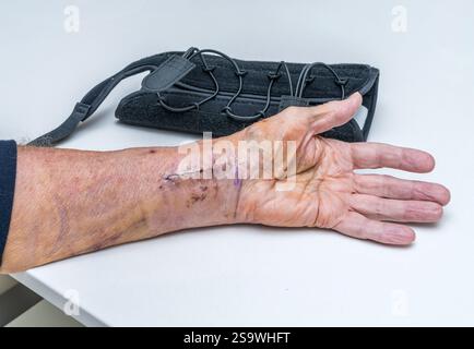 A hand with a visible surgical scar on the wrist shows signs of healing ...