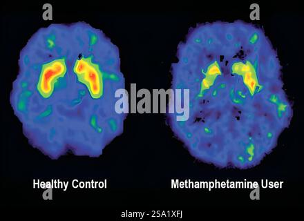 Brain Scan - Methamphetamine Stock Photo - Alamy