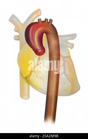 Aneurysm of the ascending thoracic aorta (aortic arch Stock Photo - Alamy