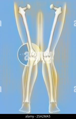 Genu valgum knock knees. Genu valgum is a deformity of the lower limb ...
