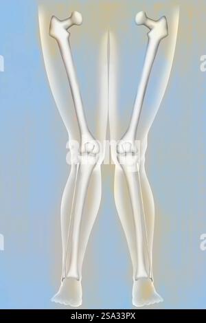 Genu valgum (knock knees Stock Photo - Alamy