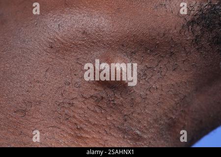 Cervical sebaceous cyst in a 29-year-old man Stock Photo - Alamy