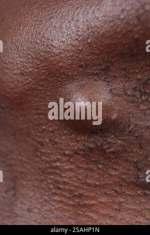 Cervical sebaceous cyst in a 29-year-old man Stock Photo - Alamy
