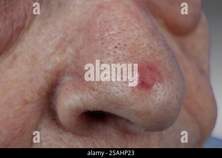 Basal cell carcinoma of the nose in an 85-year-old woman Stock Photo ...