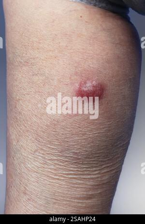 Merkel cell carcinoma of the calf in an 88-year-old man Stock Photo - Alamy