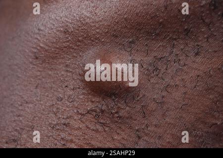 Cervical sebaceous cyst in a 29-year-old man Stock Photo - Alamy