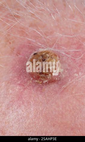 Squamous cell carcinoma of the forehead in a 76-year-old man Stock ...