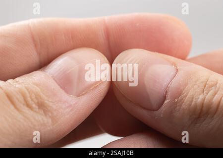 Ridged fingernails with vertical and horizontal ridges. Nails problems ...