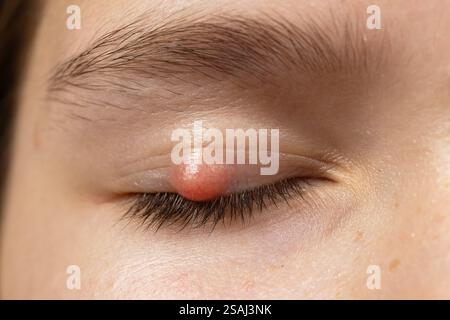 Chalazion on the eyelid of girl macro. Demodicosis mite diseas, demodex ...